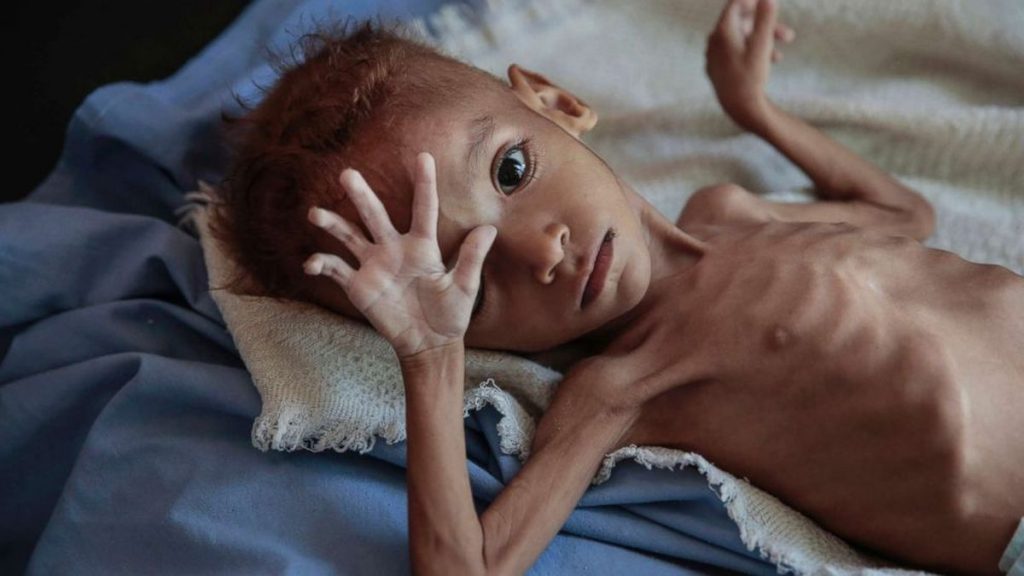 Hunger and Starvation Across the World is Affecting Half of Human Race